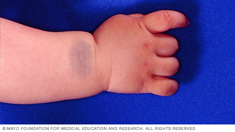Slide show: Birthmarks - Mayo Clinic
