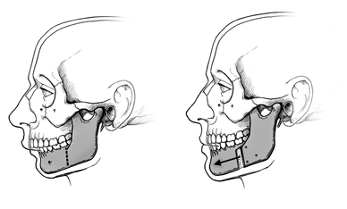 Lower jaw surgery - Mayo Clinic