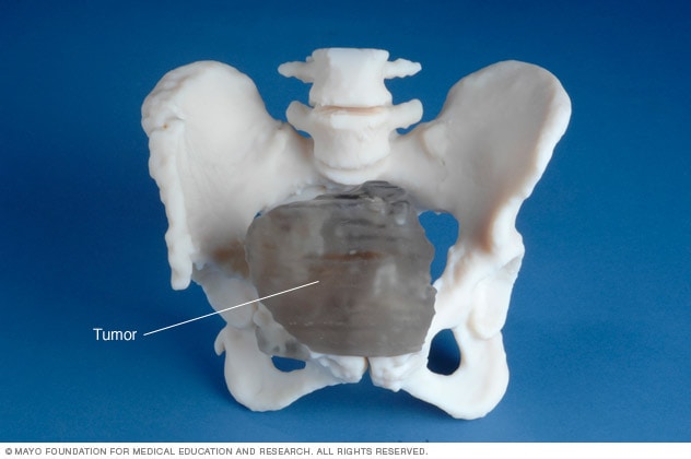 Bone cancer - Care at Mayo Clinic - Mayo Clinic