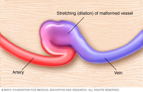 Arteriovenous fistula - Mayo Clinic