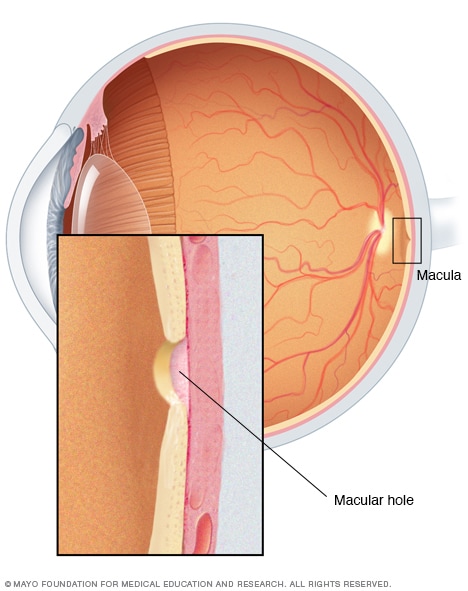Macular hole - Mayo Clinic
