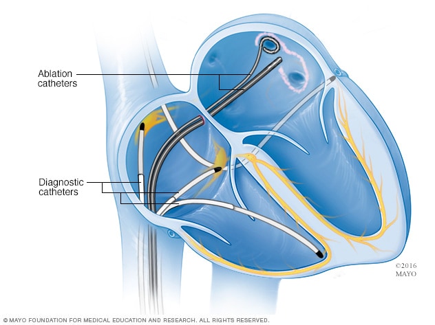 Cardiac ablation - Mayo Clinic