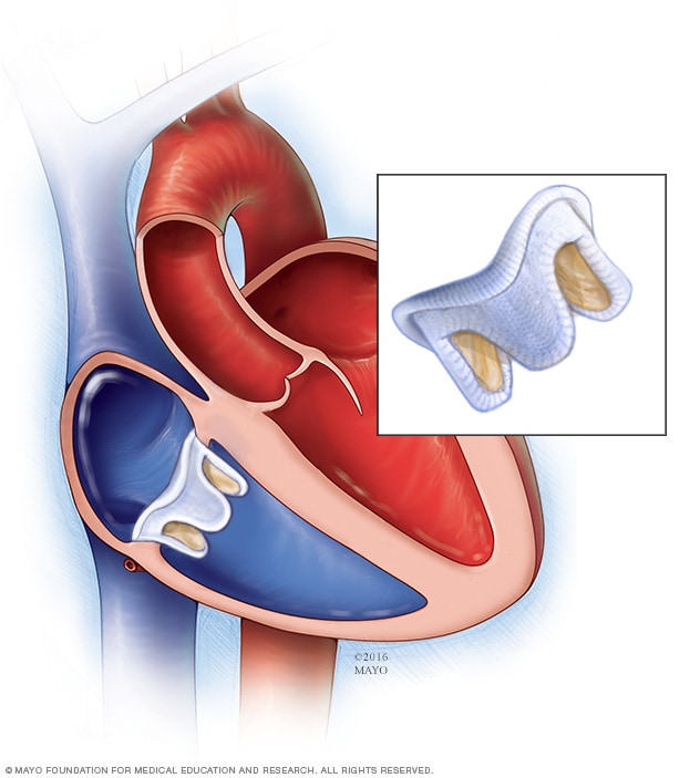 Biological tricuspid valve replacement - Mayo Clinic