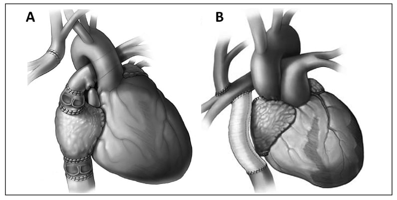Fontan Procedure