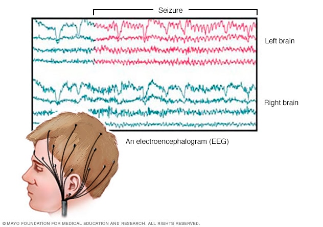 EEG brain activity - Mayo Clinic EEG brain activity - Mayo Clinic