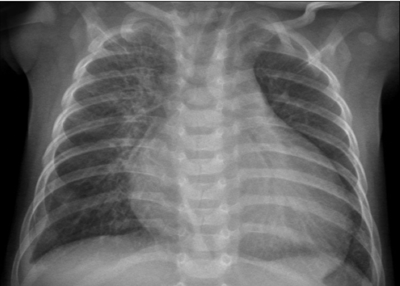 Pediatric Cardiogenic Shock What Is The Role Of Medical And Mechanical Pediatric Cardiogenic Shock What Is The Role Of Medical And Mechanical