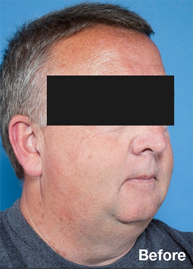 Maxillomandibular advancement surgery: A classic procedure refined ...