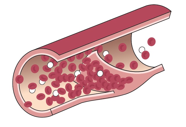 Spontaneous coronary artery dissection (SCAD) - Symptoms and causes ...
