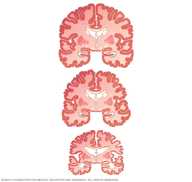 Mild Cognitive Impairment