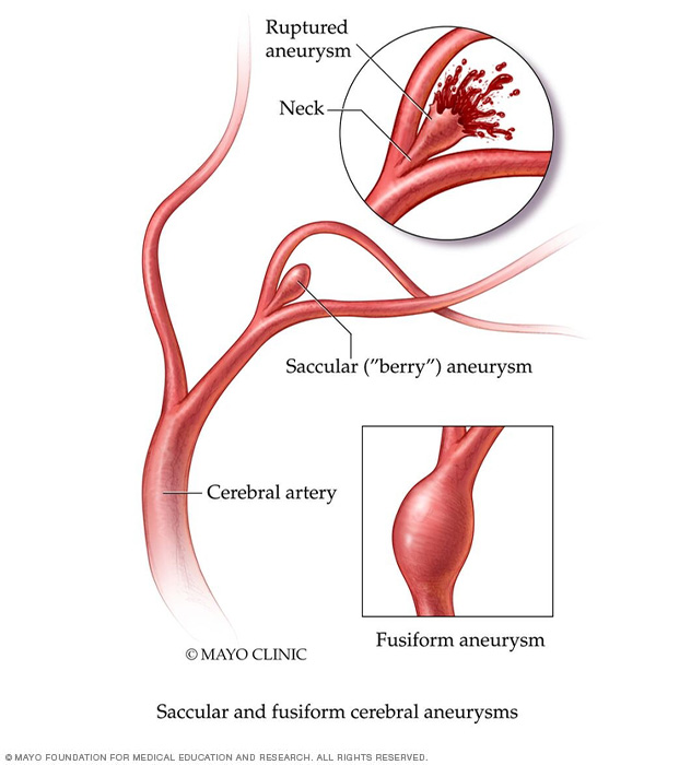 Ruptured Cerebral Aneurysm Icd Shop Deals Deborahsilvermusic Ruptured Cerebral Aneurysm Icd Shop Deals Deborahsilvermusic