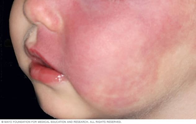 Types Of Birthmarks Birthmark Pictures Wellness