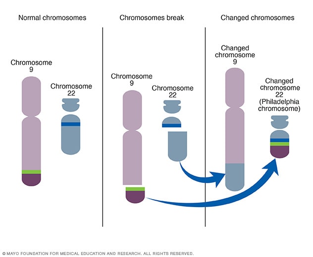 How the Philadelphia chromosome forms - Mayo Clinic