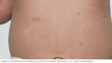 Slide show: Birthmarks - Mayo Clinic