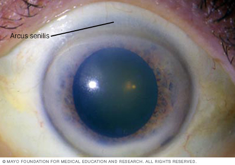 Arcus senilis: A sign of high cholesterol? - Mayo Clinic
